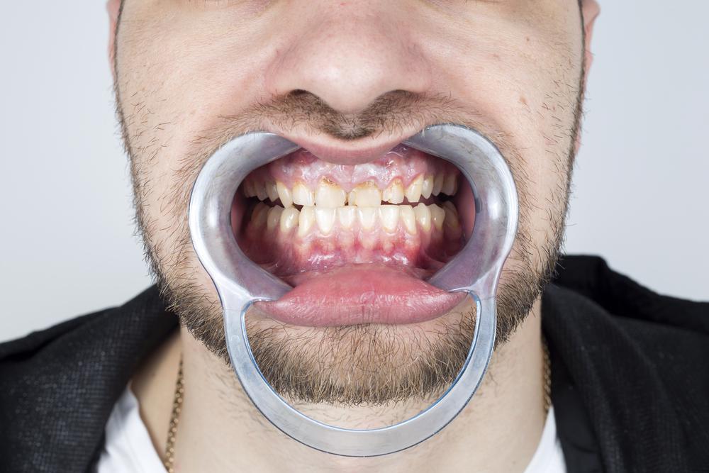 Understanding Calcium Deposits and How They Affect Your Teeth – NUDE MINTS